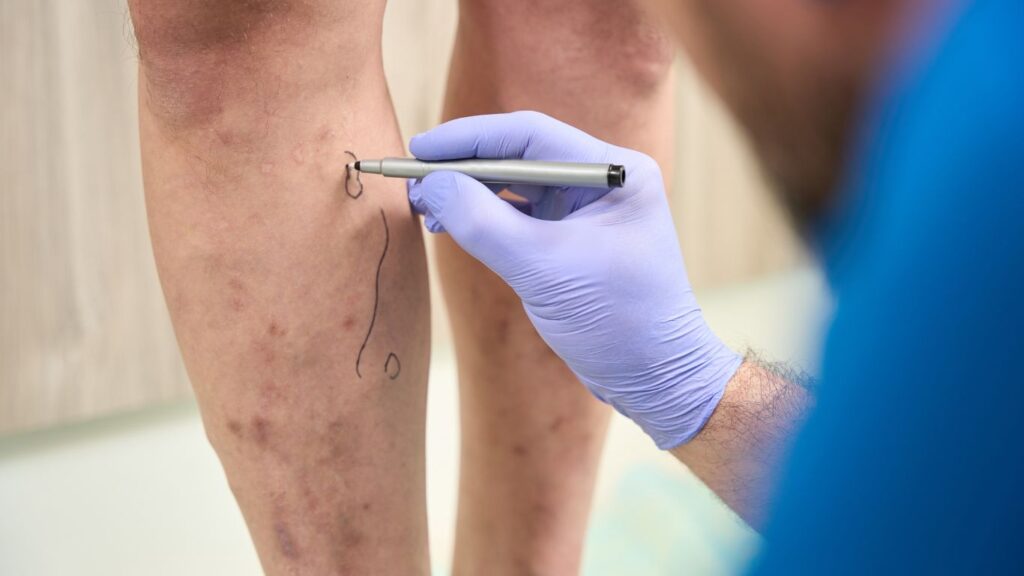 Vein Matting After Sclerotherapy - Laurel Clinical